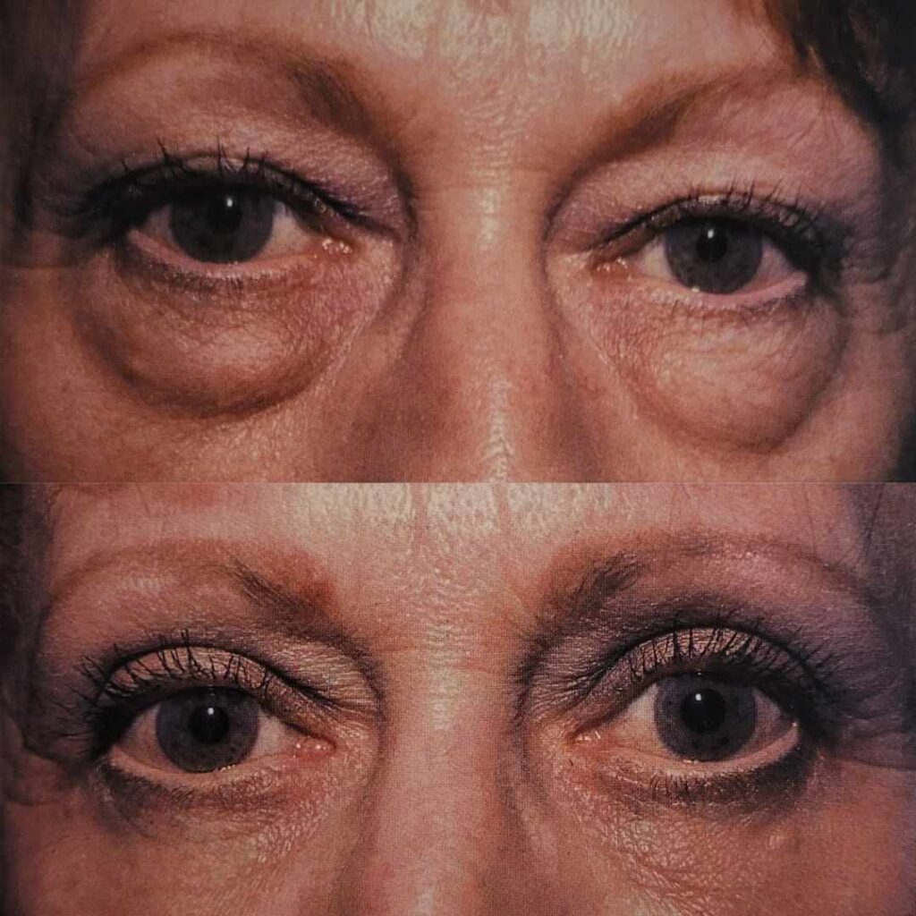 Blefaroplastia: tipos de procedimentos e suas indicações Home - Dr.Angelino